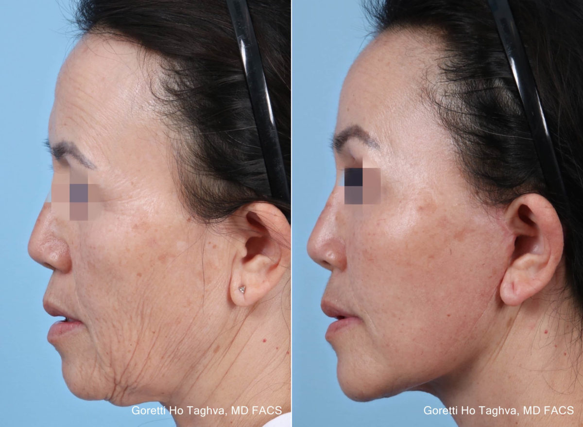 Tips for Managing Scars Behind Ears After a Facelift