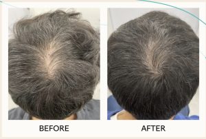 FoLix by Lumenis Newport Beach | Laser for Hair Loss